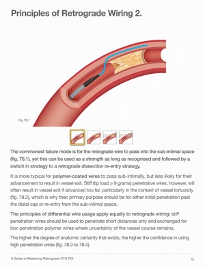 ‎A guide to mastering Retrograde CTO PCI on Apple Books